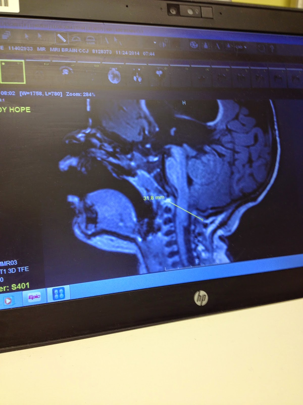 Update from Sedated MRI, VCUG, and Sleep Study Follow-up